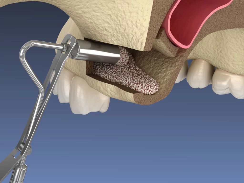 Sinus Lift Procedure: What to Expect Step-by-Step